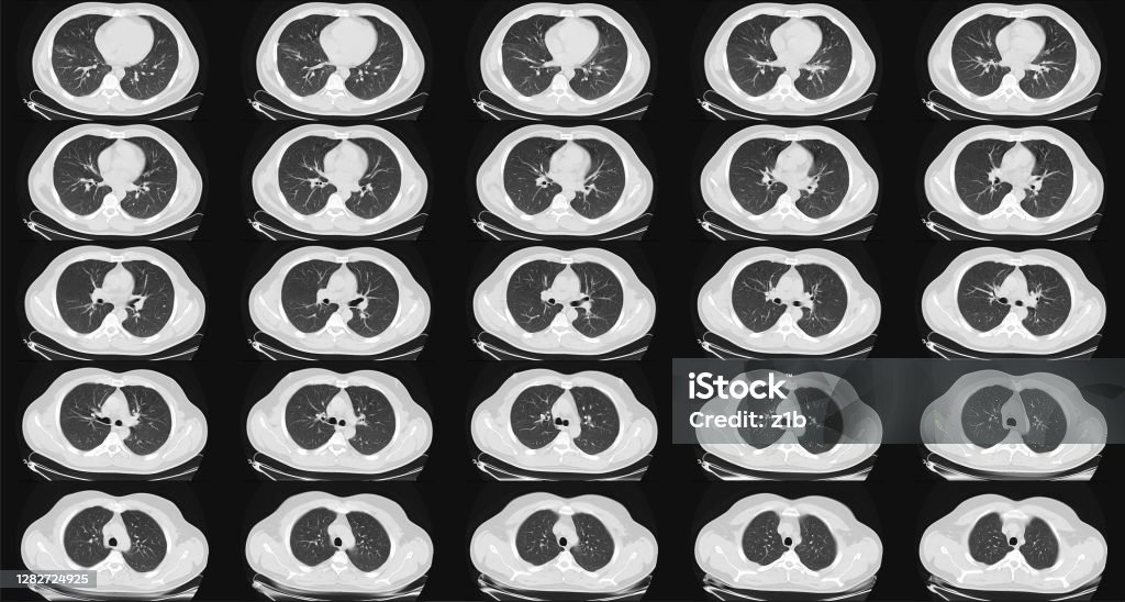 Menghitung Tomografi Paruparu Pada Pria Dewasa Yang Sehat Normal