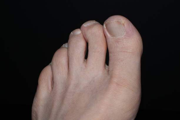 Crooked Toe
