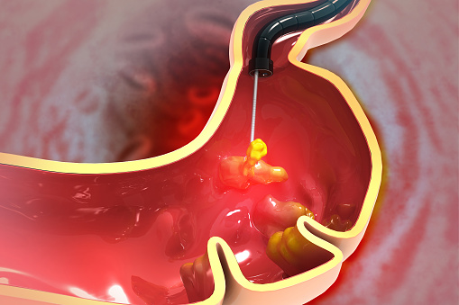 Photo Libre De Droit De Cancer De Lestomac Cellule Dattaque De Cancer