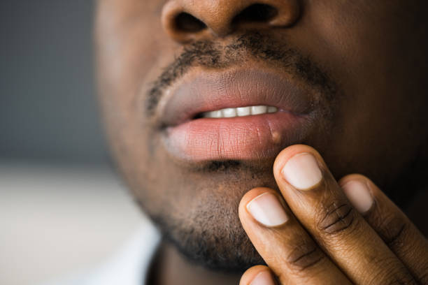 4 600 Herpes Fotos Fotografías De Stock Fotos E Imágenes Libres De