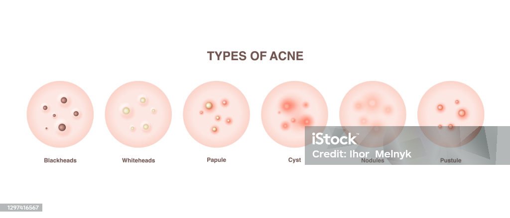 Types Of Acne Diagram