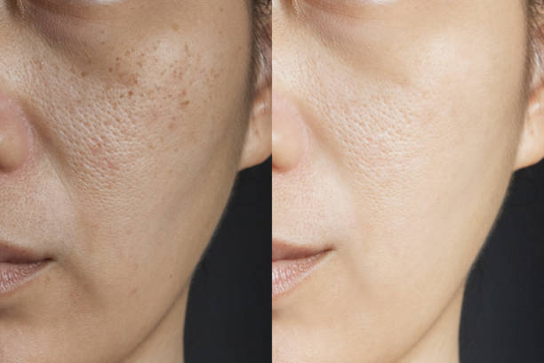 APLB Glutathione Hyaluronic Acid Whitening Cream | ubicaciondepersonas ... APLB Glutathione Hyaluronic Acid Whitening Cream | ubicaciondepersonas ...