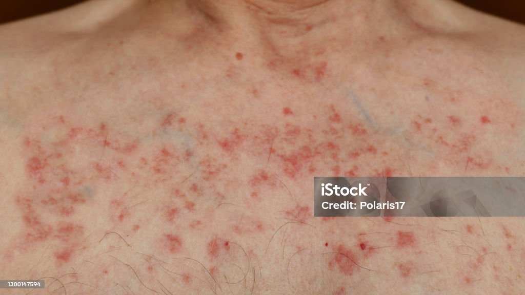 Skin Reaction On A Man Chest After Chemotherapy Allergic Reaction Allergic Rash On Chest Skin