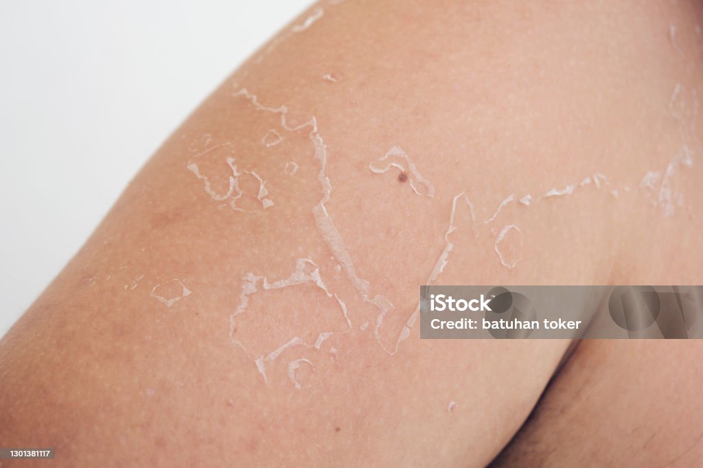 Peeling Skin At Back And Shoulder From Sunburn Effect On Body Of Young