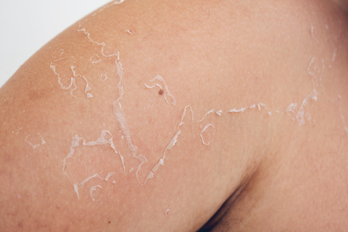 Peeling Skin At Back And Shoulder From Sunburn Effect On Body Of Young