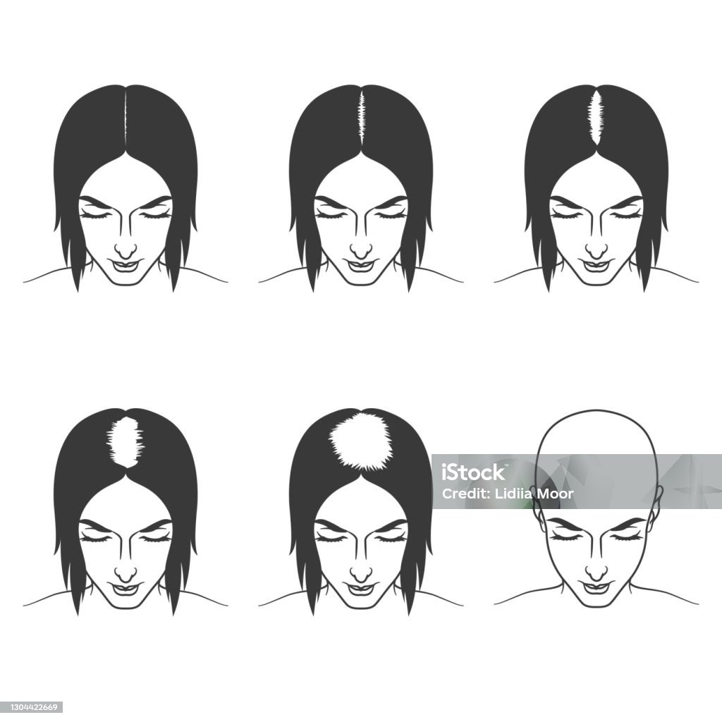 Stages Of Female Hair Loss Stock Illustration Download Image Now