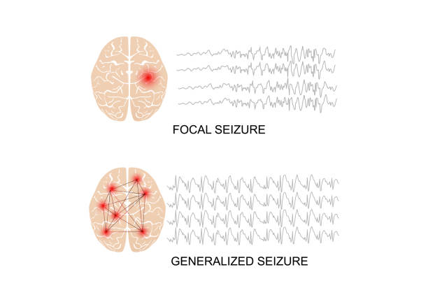 Epilepsy Seizures Illustrations Royalty Free Vector Graphics And Clip