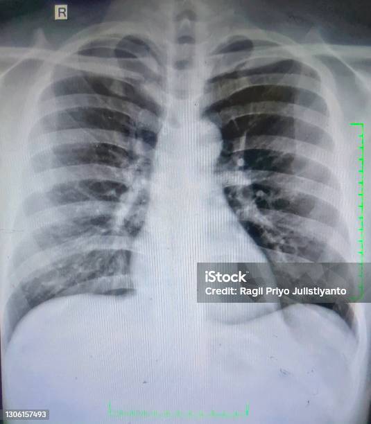 Xray Dada Foto Stok Unduh Gambar Sekarang Dokter Gambar X Ray