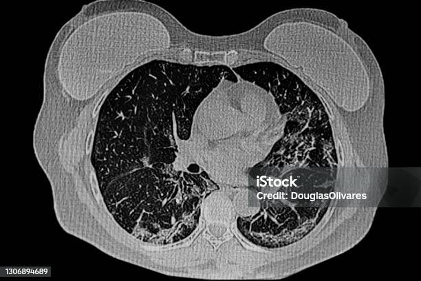 Ct Scan Dada Pasien Wanita Dengan Protesis Payudara Dan Infeksi