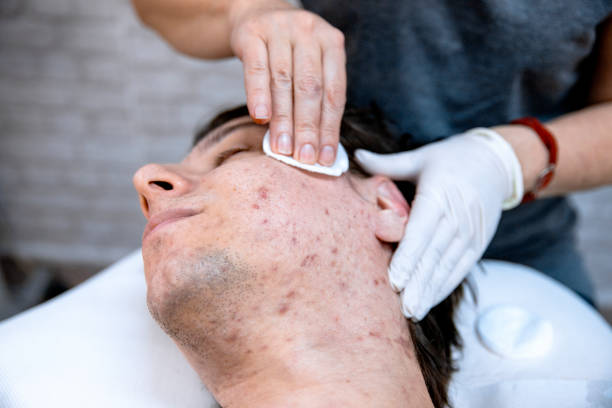 What is Acnelan treatment? - The Beauty Lounge Toronto
