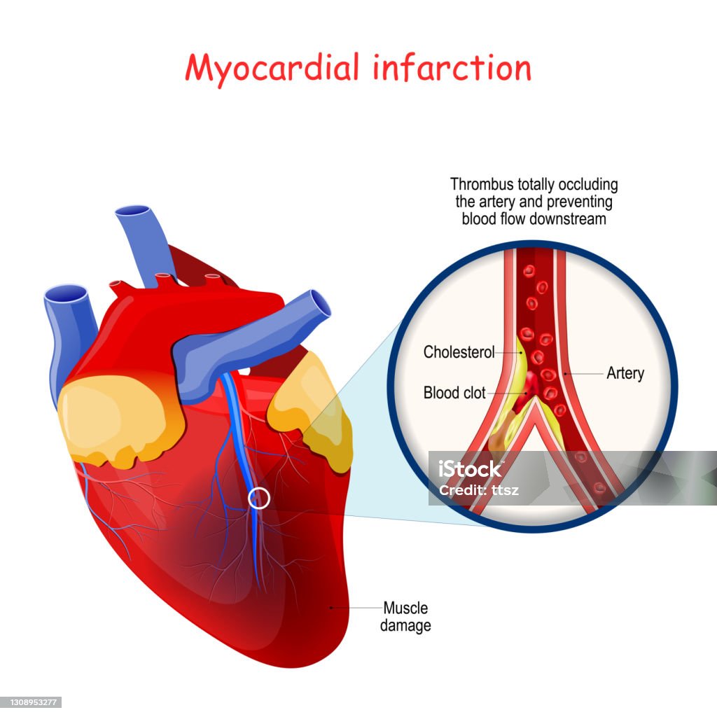 Myocardial Infarction Heart Attack Stock Illustration Download Image