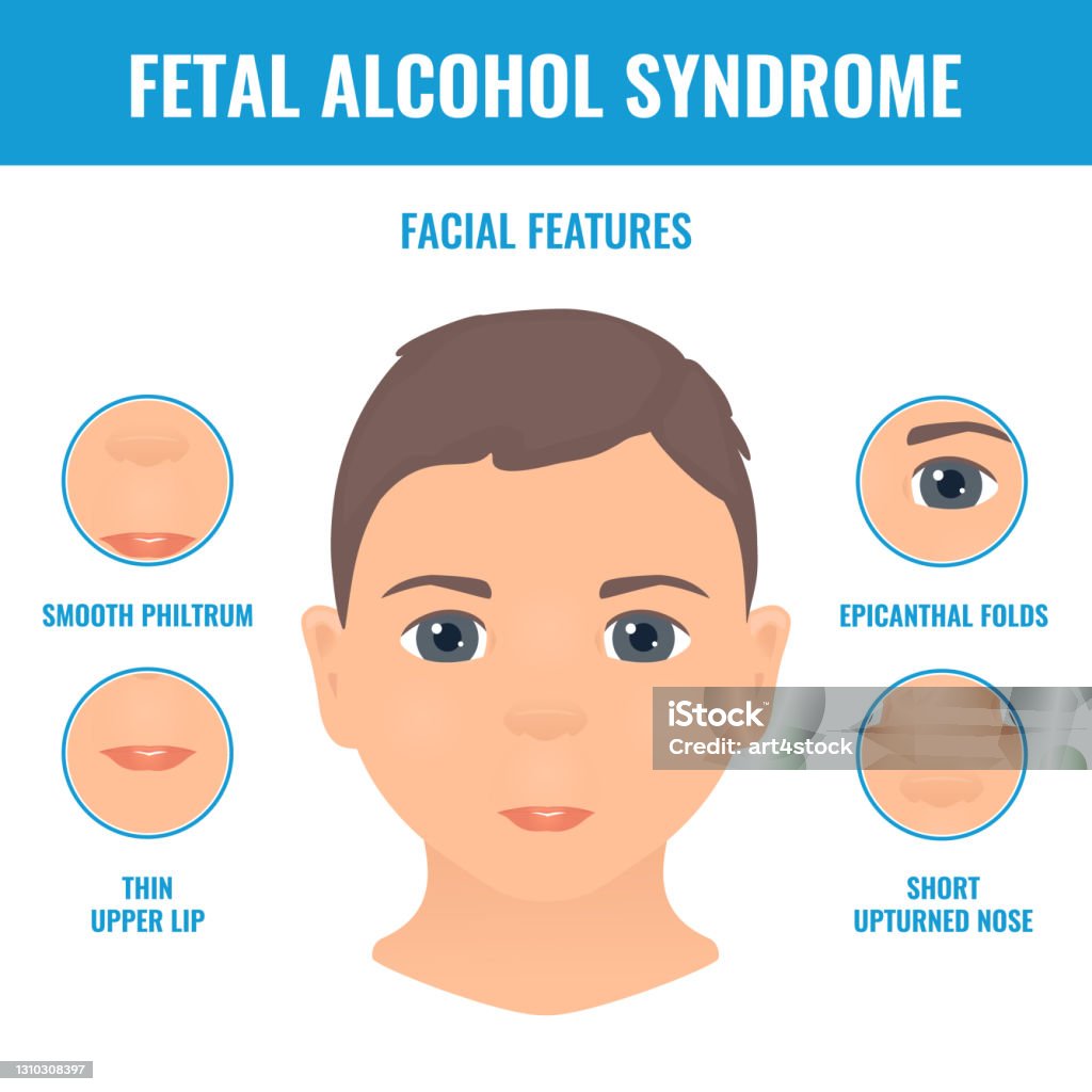 Fetal Alcohol Syndrome Facial Features In A Child Stock Illustration ... Fetal Alcohol Syndrome Facial Features In A Child Stock Illustration ...