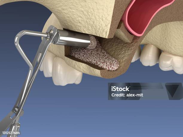 Cirugía De Elevación De Senos Paranasales Adición De Hueso Nuevo Ilustración 3d Foto De Stock Y