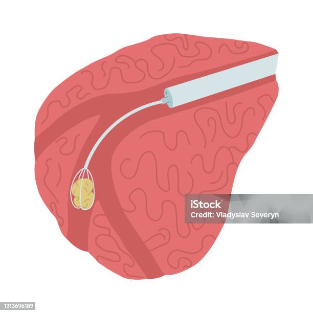 Vectorillustratie Van Endoscopische Chirurgie Om Een Steen Uit De ... Vectorillustratie Van Endoscopische Chirurgie Om Een Steen Uit De ...