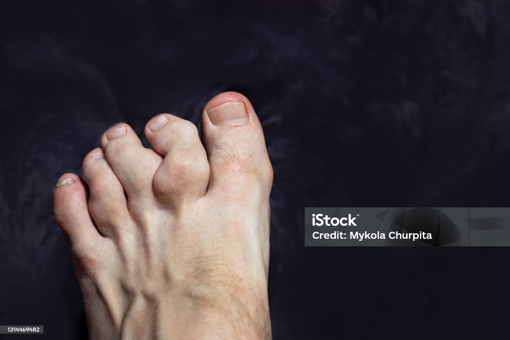 Inflammation And Deformity Of The Toes Gouty Toes Toes Affected By Gout