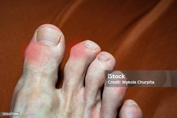 Closeup Of Deformed Toes After Multiple Fractures Swelling Of The
