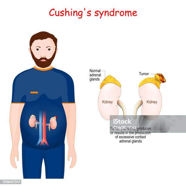 Cushings Syndrome Stock Illustration Download Image Now Cushings