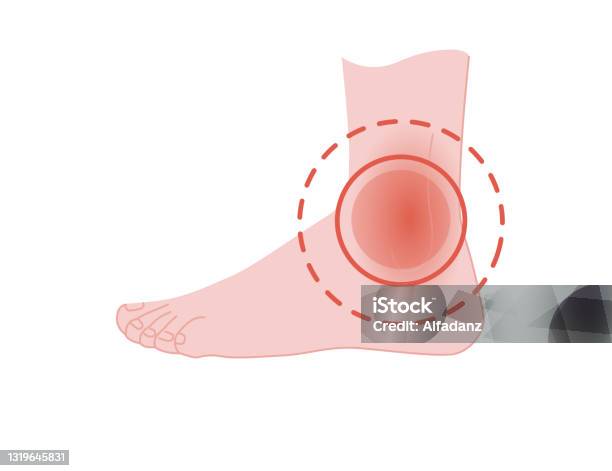 Vetores de Conceito Doloroso Do Pé Da Perna Com Dor Calcanhar Vermelho ... Vetores de Conceito Doloroso Do Pé Da Perna Com Dor Calcanhar Vermelho ...