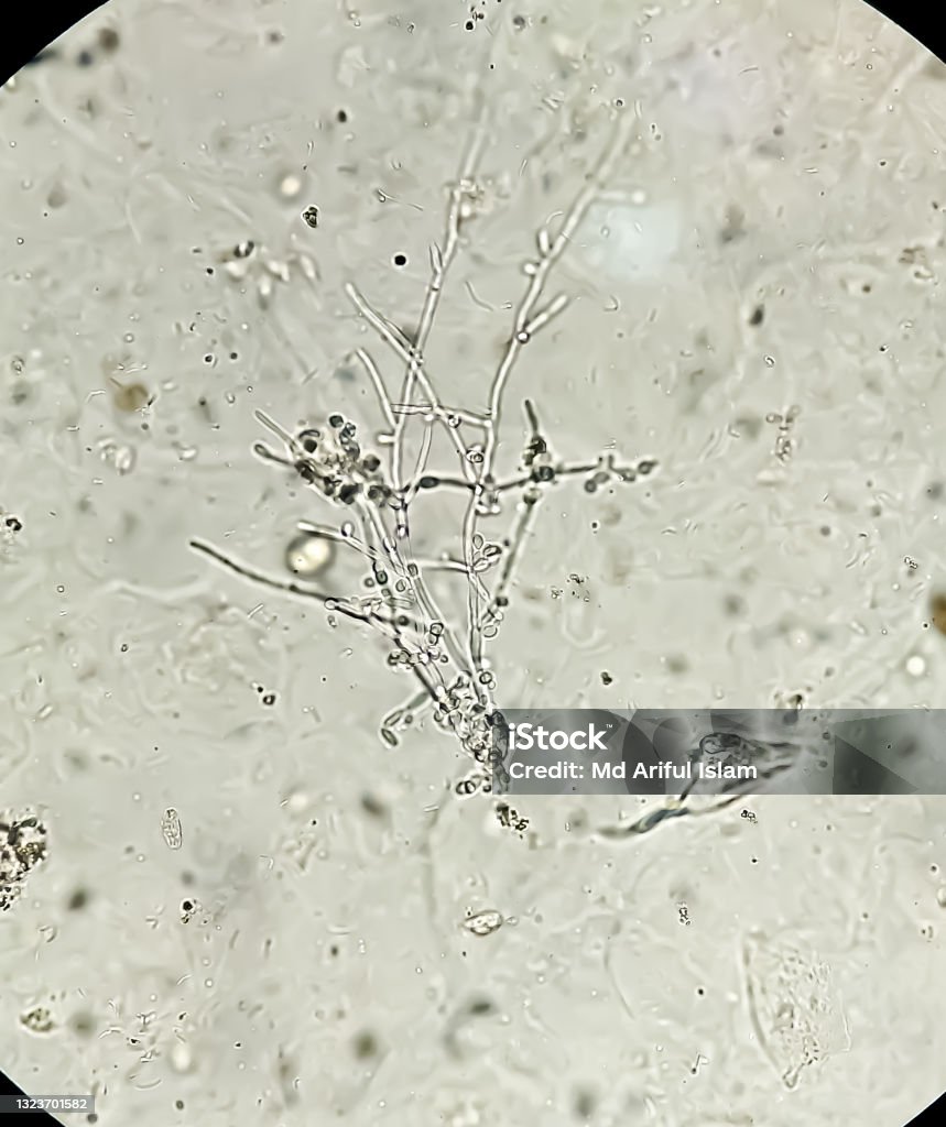 Infeksi Jamur Pemula Ragi Dan Pseudohyphae Dari Candida Albicans Jamur