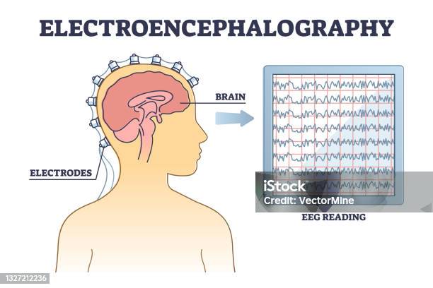 Electroencephalography หรือ Eeg เป็นแผนภาพเค้าร่างการตรวจสอบการทํางาน