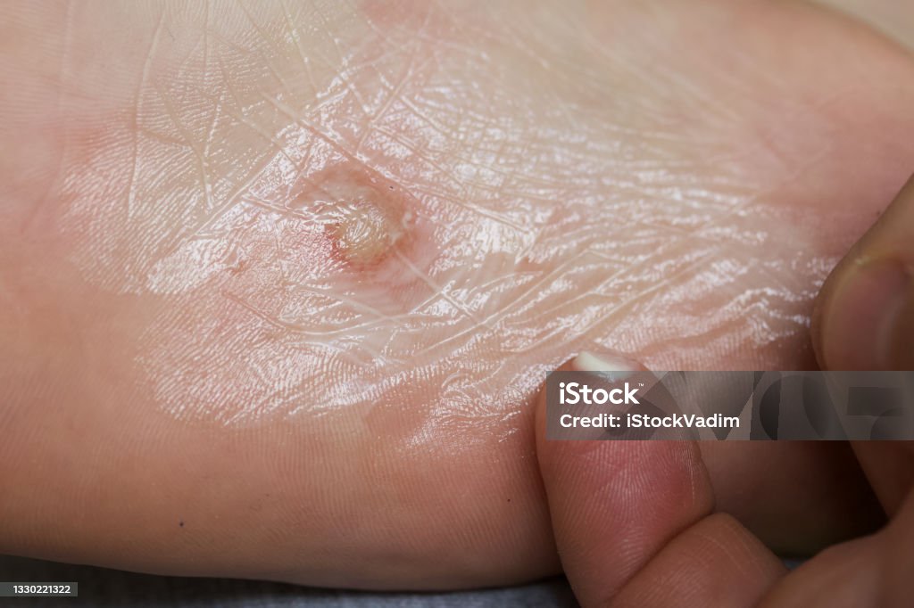 Dyshidrotic Eczema On The Foot Blister Dermatitis It Is Treated With Ointment Closeup Shot Stok