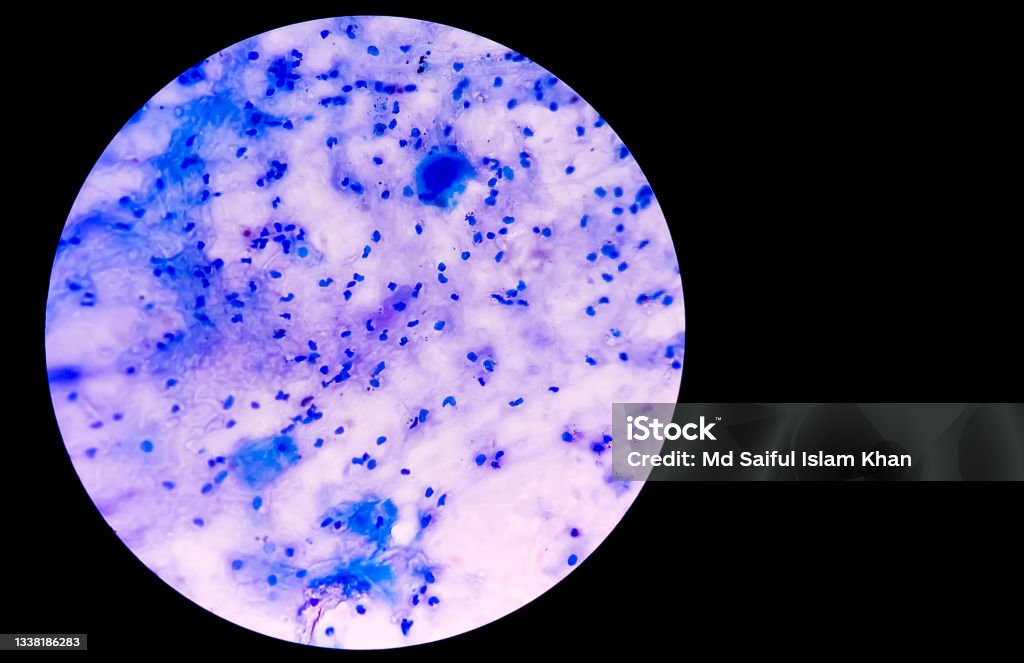 Sputum Smear Under Microscopy Showing Gram Positive Cocci Bacteria Smear Of Grams Stained From