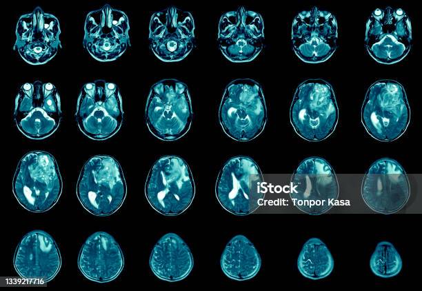 Magnetic Resonance Imaging Finding 5 Cm Isodense Mass With Illdefined