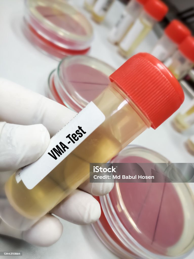 Urine Sample For Vma Test used To Detect Neuroblastomas And ... Urine Sample For Vma Test used To Detect Neuroblastomas And ...