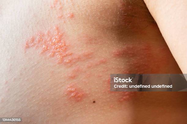 Hautinfiziert Herpes Zoster Virus Herpesvirus Am Körper Urtikaria
