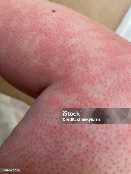 Hives Heat Rash Eai Erythema Ab Igne Heat Reaction On Knee Closeup Reference Picture Of Blotchy