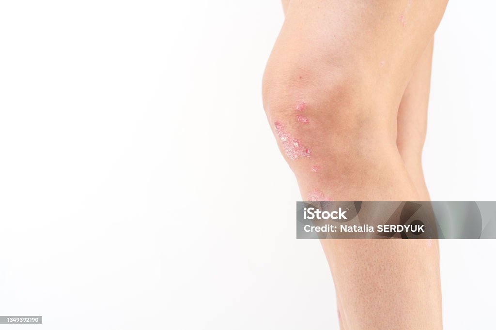 Acute Psoriasis On The Knees Is An Autoimmune Incurable Dermatological