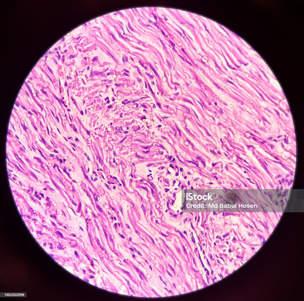 Microscopic Image Of Chronic Epididymoorchitis In Testis Tissues