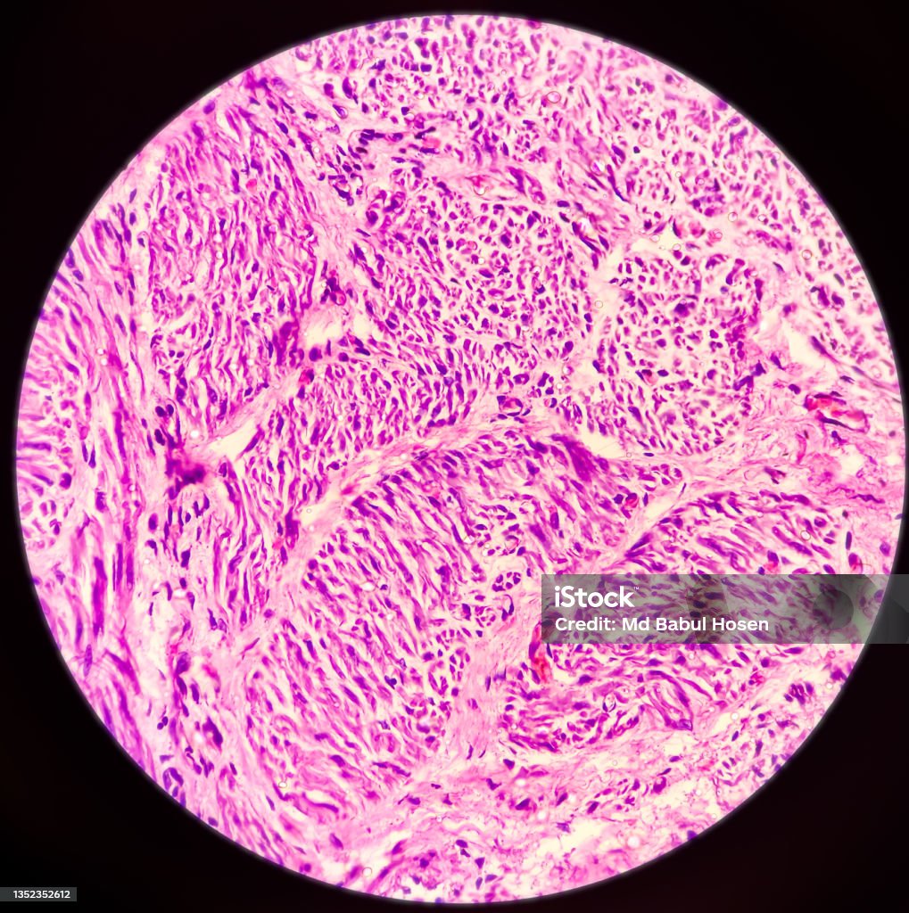 Microscopic Image Of Chronic Epididymoorchitis In Testis Tissues ... Microscopic Image Of Chronic Epididymoorchitis In Testis Tissues ...
