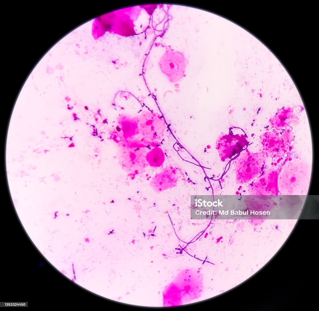 Gram Stain Gram Positive Cocci Gram Positive Diplococci Bacteria Candida Present Squamous