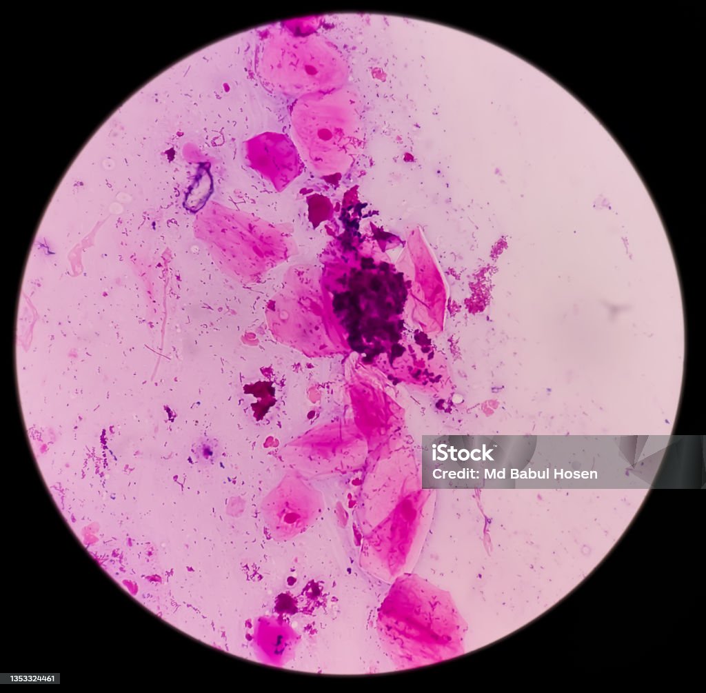 Gram Stain Gram Positive Cocci Gram Positive Diplococci Bacteria Candida Present Squamous