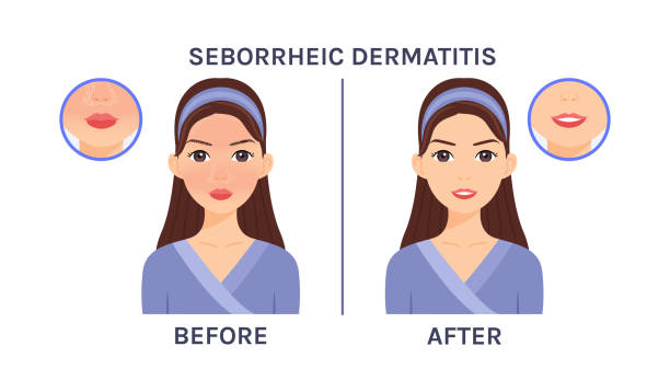 50 Dermatitis Seboroik Ilustrasi Foto Stok Potret And Gambar Bebas