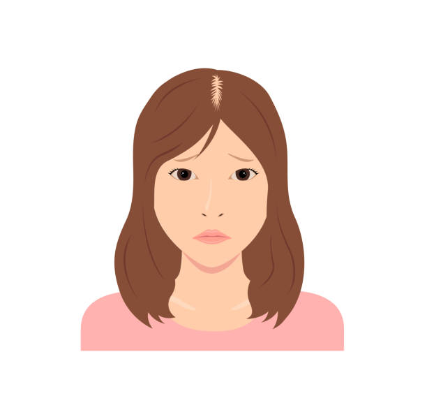 60 Androgenetic Alopecia Stock Illustrations Royalty Free Vector