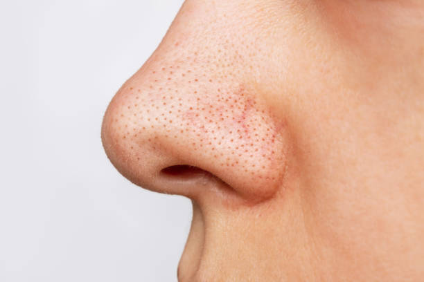 1,100+ Woman Nose Pores Stock Photos, Pictures & Royalty-Free Images ... 1,100+ Woman Nose Pores Stock Photos, Pictures & Royalty-Free Images ...
