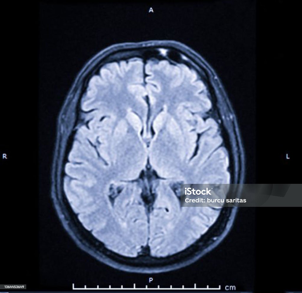 Pemindaian Mri Otak Pemindaian Gambar Resonansi Magnetik Otak Alat ... Pemindaian Mri Otak Pemindaian Gambar Resonansi Magnetik Otak Alat ...