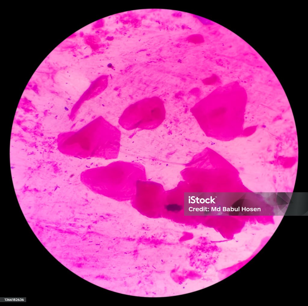 Gram Stain Of Throat Swab Microscopic View Show Plenty Epithelial Cells And Few Gram Positive