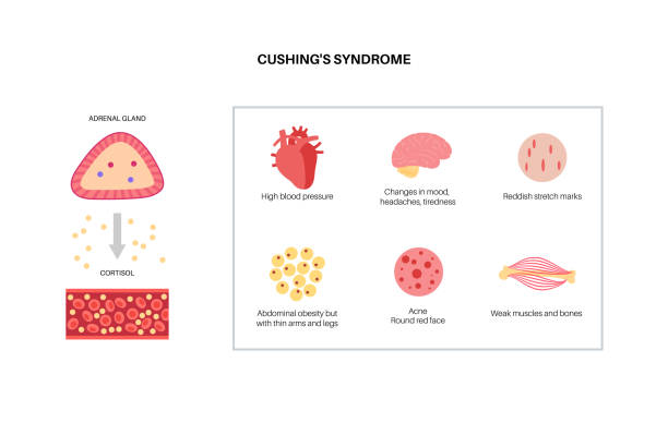 30 Cushings Syndrome Illustrations Stock Illustrations Royalty Free