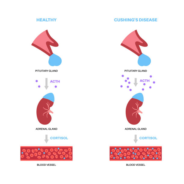 40 Cushings Syndrome Stock Illustrations Royalty Free Vector Graphics