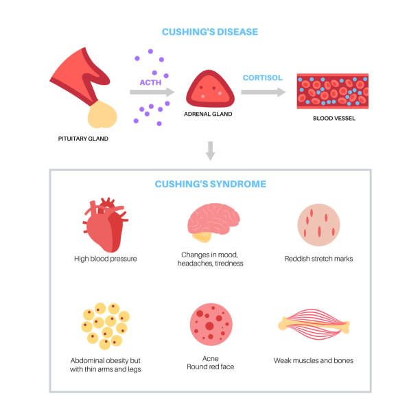 40 Cushings Syndrome Stock Illustrations Royalty Free Vector Graphics