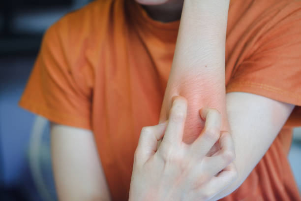 50+ Infected Forearm From Mosquito Bite Stock Photos, Pictures ... 50+ Infected Forearm From Mosquito Bite Stock Photos, Pictures ...