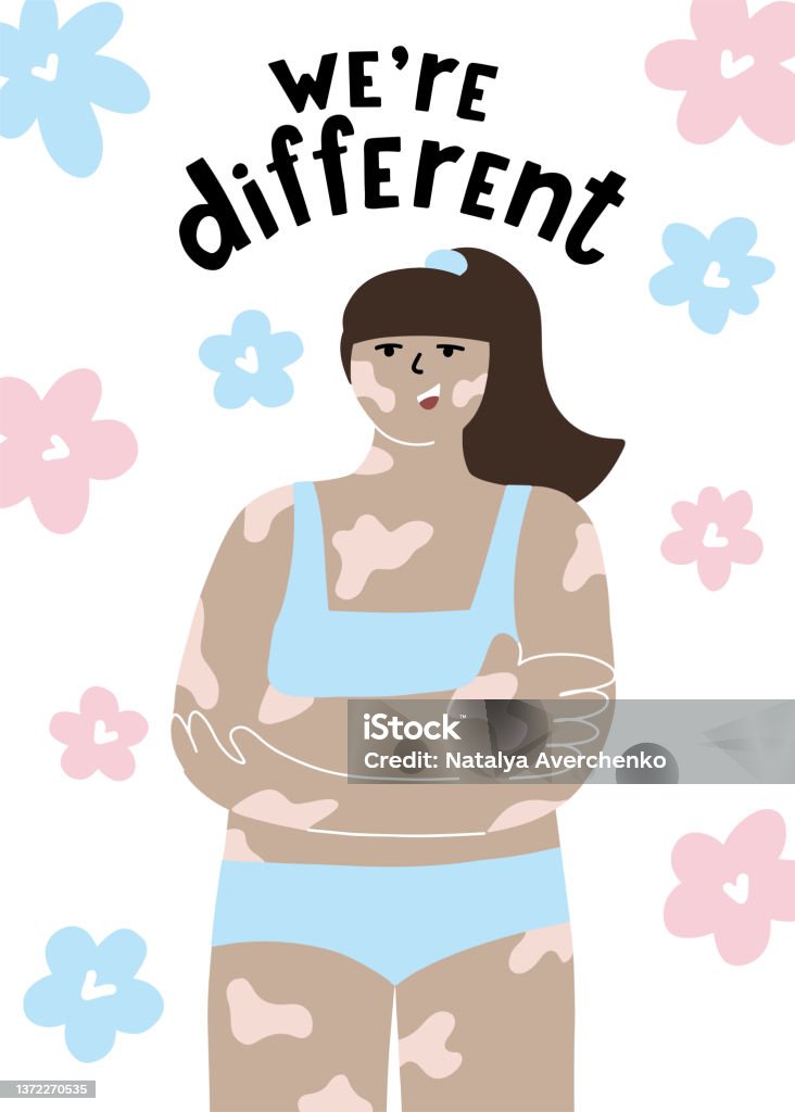 Femme Avec La Peau De Vitiligo Vecteurs Libres De Droits Et Plus Dimages Vectorielles De Adulte