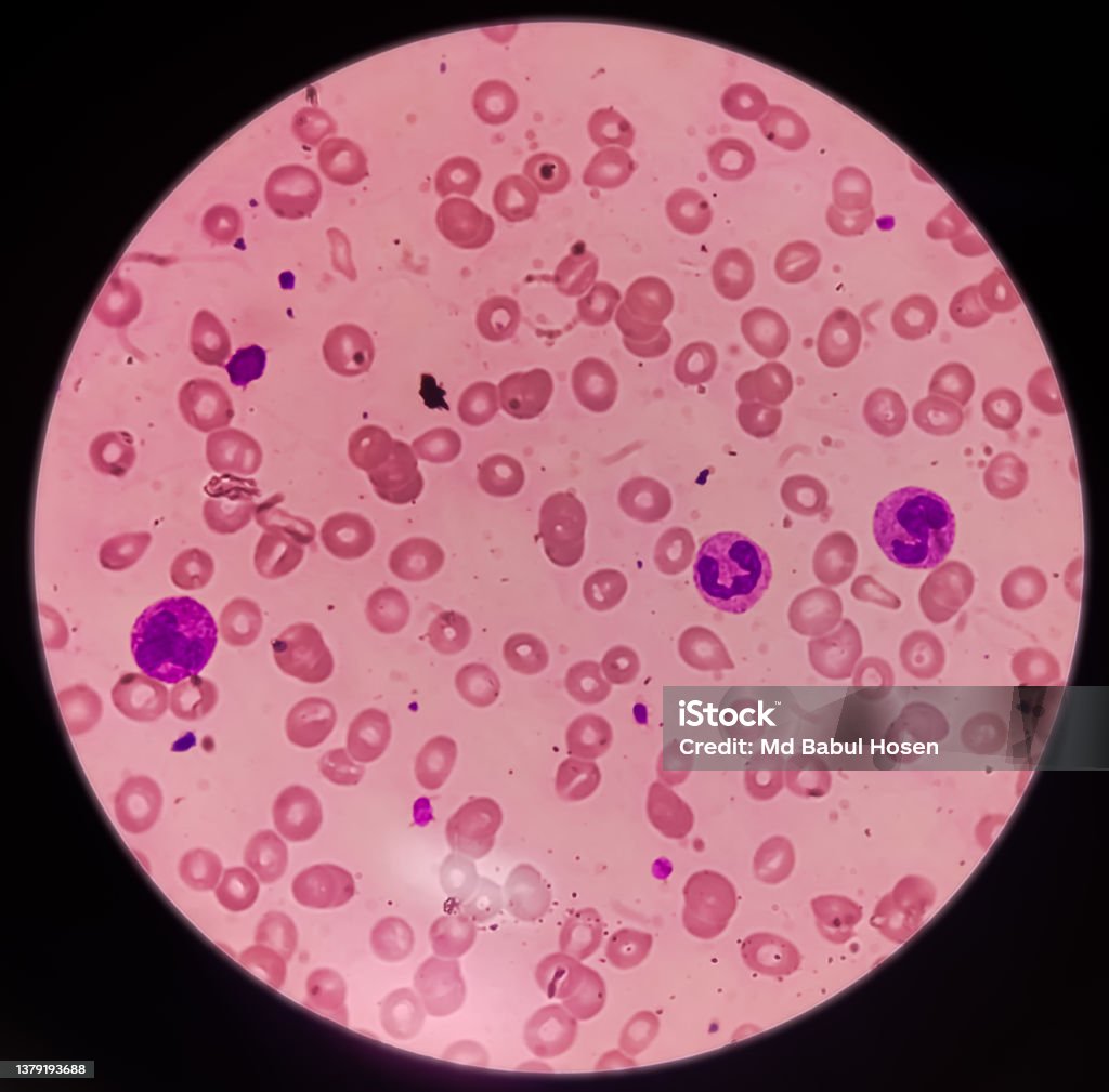 Foto de Imagem Microscópica De Anemia Macrocítica Com Trombocitopenia ... Foto de Imagem Microscópica De Anemia Macrocítica Com Trombocitopenia ...