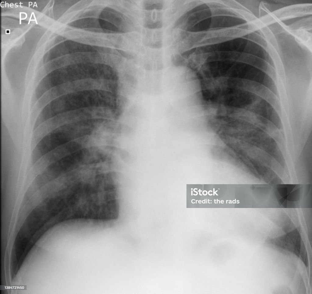Chest X Ray Of Covid 19 Pneumonia Stock Photo - Download Image Now ... Chest X Ray Of Covid 19 Pneumonia Stock Photo - Download Image Now ...