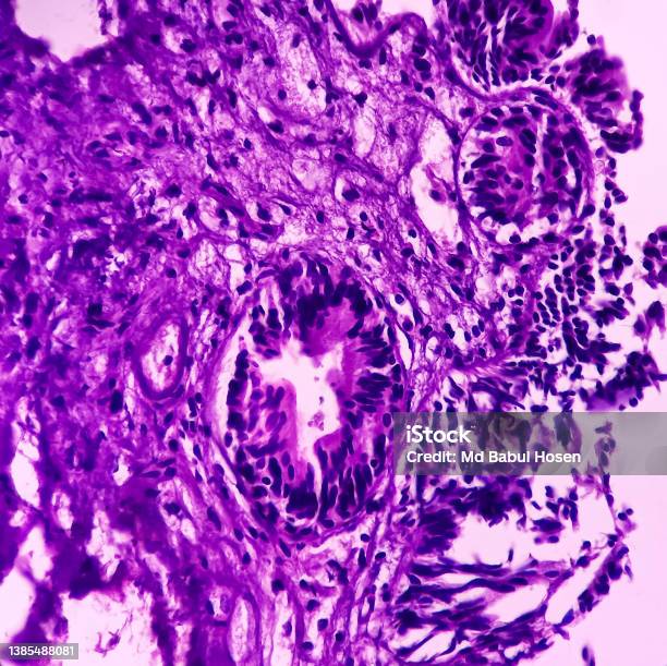 Cancro Alla Prostata Adenocarcinoma Neoplasia Maligna Cellule ... Cancro Alla Prostata Adenocarcinoma Neoplasia Maligna Cellule ...