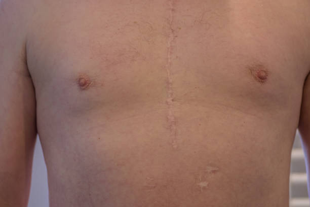 Open Heart Surgery Scar Open Heart Surgery Scar