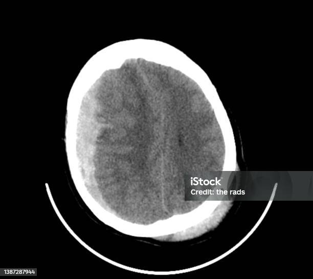 Traumatic Brain Injuries Ct Scan Image Stock Photo - Download Image Now ... Traumatic Brain Injuries Ct Scan Image Stock Photo - Download Image Now ...
